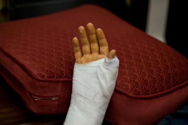 Hand in Cast | Tellwut.com