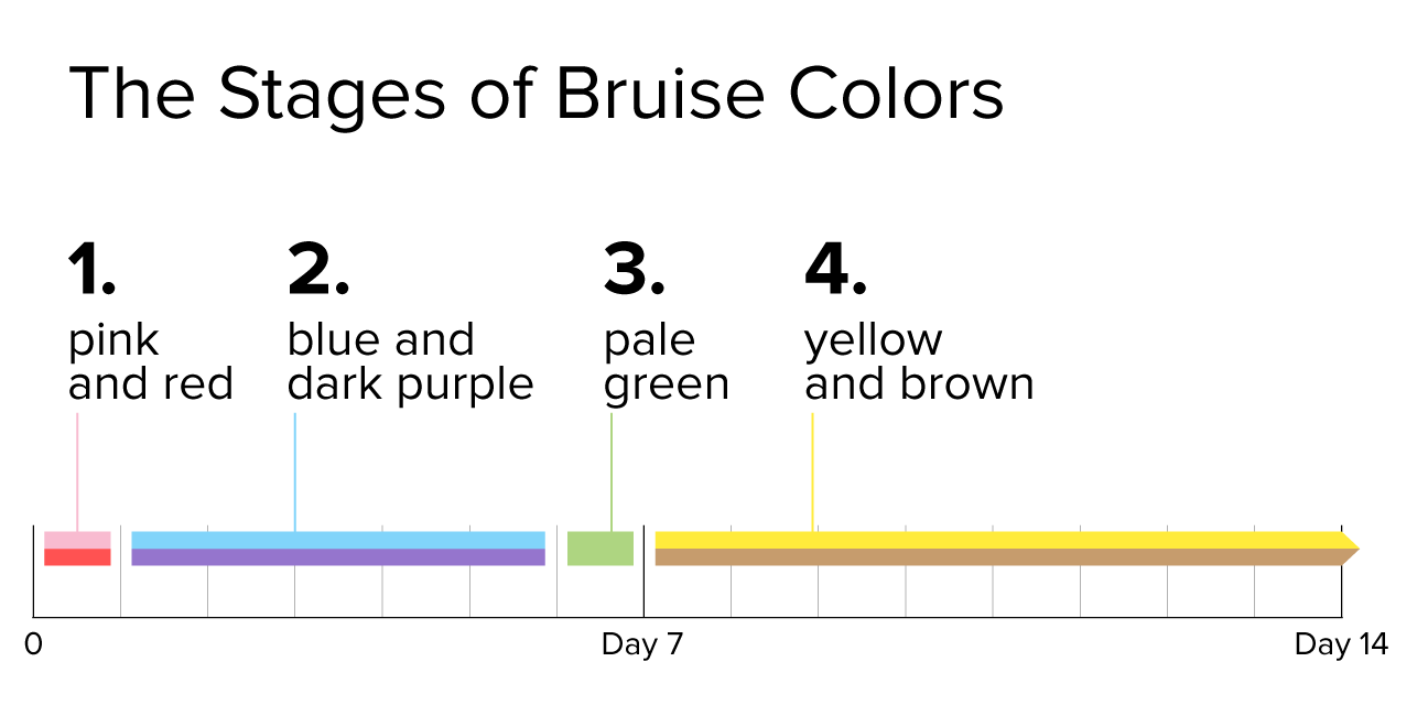 The stages and colors bruises | Tellwut.com