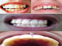 Extreme Oral Piercings -- Not For Squeamish | Tellwut.com