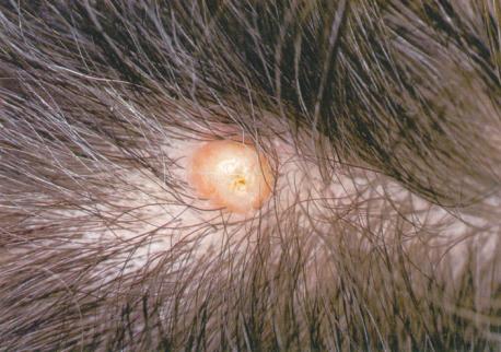 Did you ever have trichilemmal cysts? | Tellwut.com
